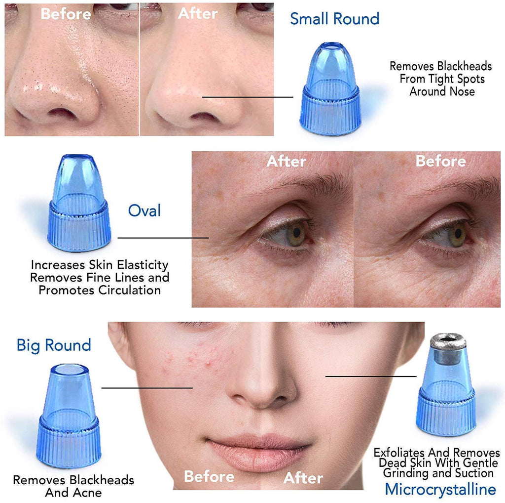 Derma Suction Blackhead Acne Oil Remover Vacuum Suction Face – Smart-Hub.pk